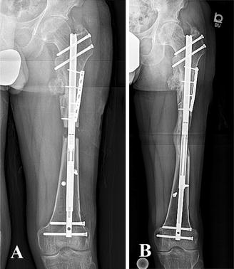 The use of blocking screws with internal lengthening nail and reverse ...