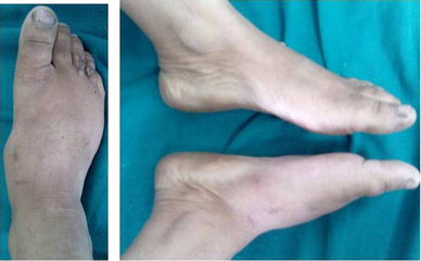 An old mismanaged Lisfranc injury treated by gradual deformity ...