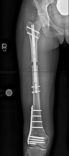 Distal femoral flexion deformity from growth disturbance treated with a ...