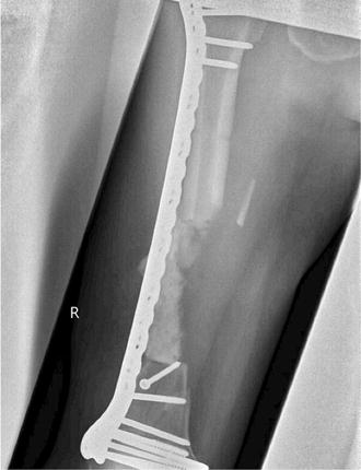 Bridging hard callus at 48 days in an open femoral shaft fracture with ...