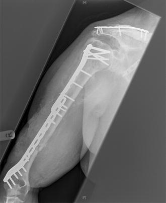 Bridging hard callus at 48 days in an open femoral shaft fracture with ...