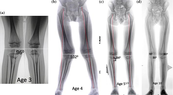 Cozen’s deformity: resolved by guided growth | SpringerLink