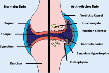 Arthrose | SpringerLink