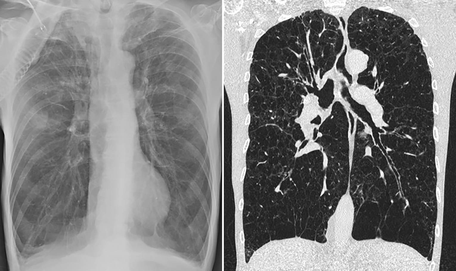 Chronisch obstruktive Lungenerkrankung (COPD) | SpringerLink
