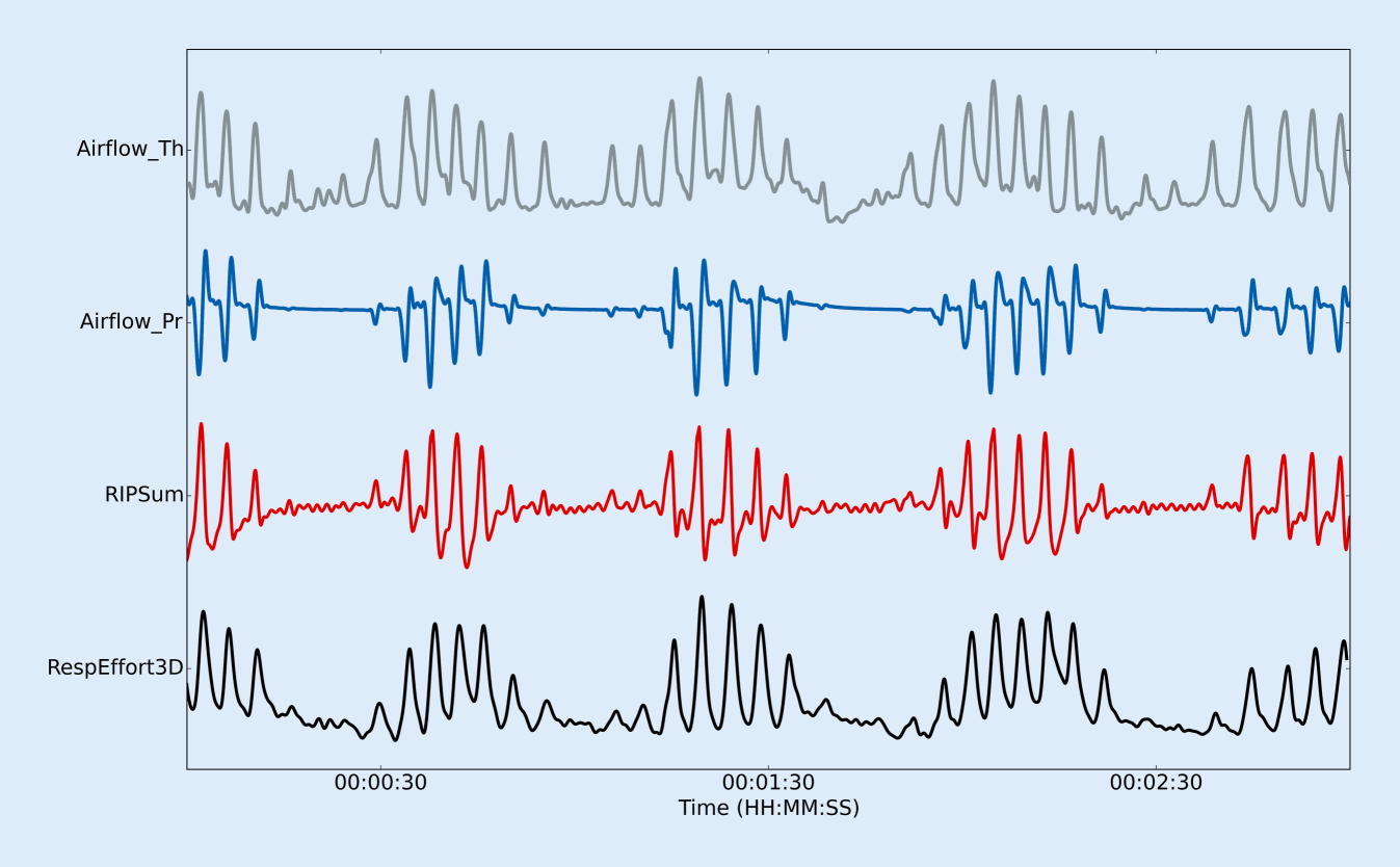 Measurement of respiratory effort in sleep by 3D camera and respiratory ...
