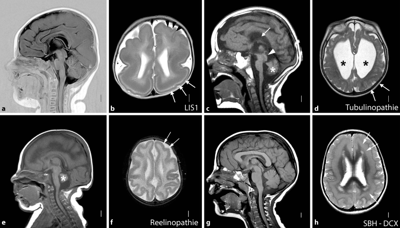 Genetik der kortikalen Fehlbildungen | SpringerLink