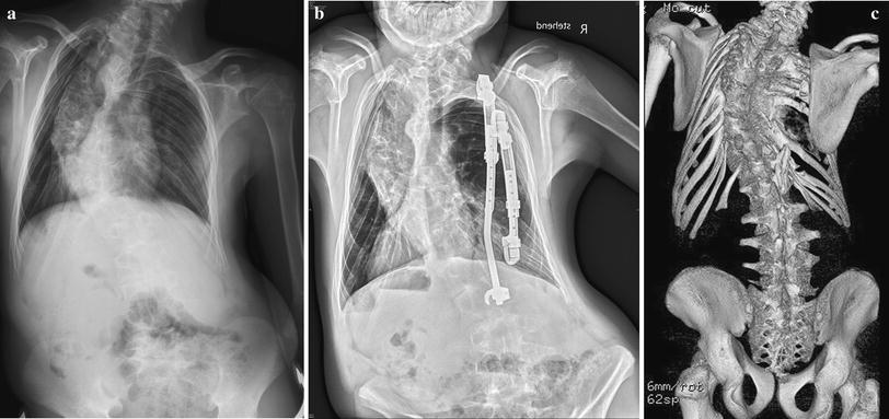 Extraspinal ossifications after implantation of vertical expandable ...