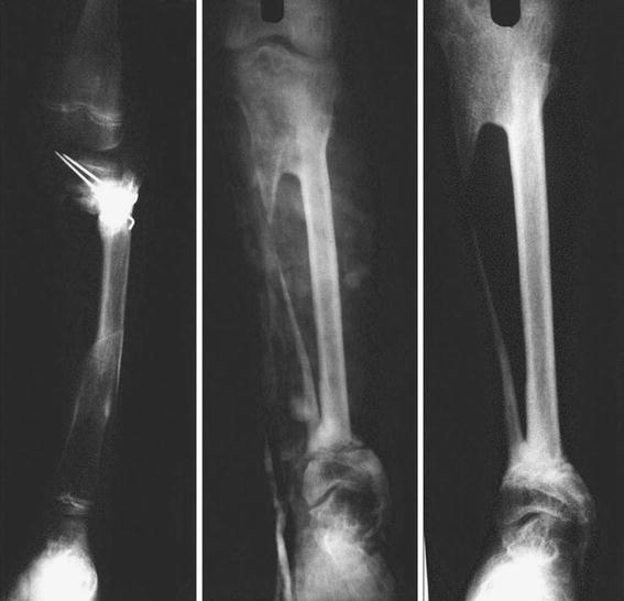 The Huntington procedure: still a reasonable option for large tibial ...
