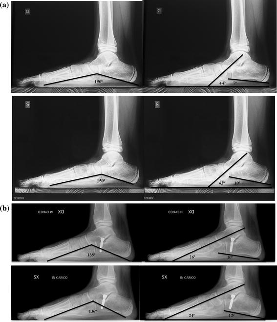 Subtalar extra-articular screw arthroereisis (SESA) for the treatment ...