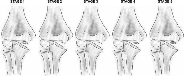 Hegemann’s disease and fishtail deformity: aetiopathogenesis ...