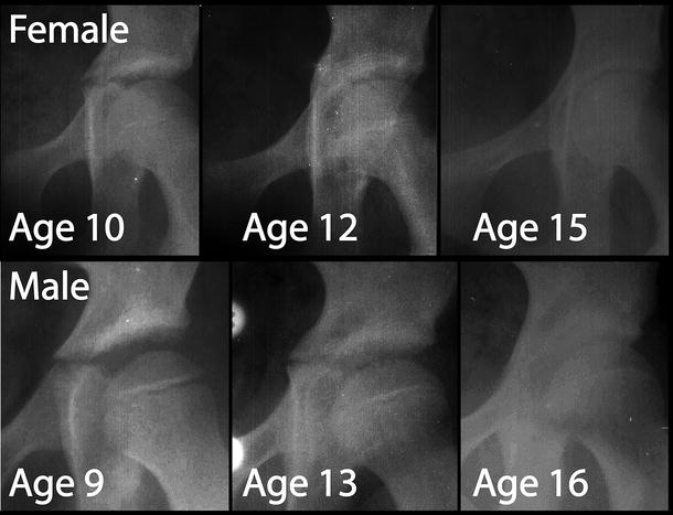 The ‘triradiate bump’: a novel radiographic sign that may confound ...
