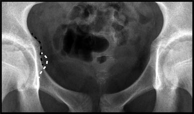 The ‘triradiate bump’: a novel radiographic sign that may confound ...