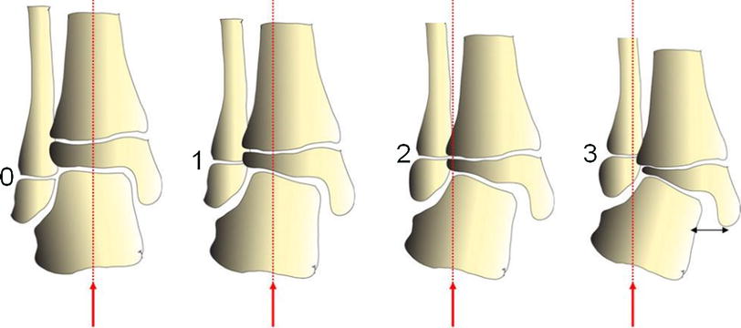 Correction of ankle valgus by hemiepiphysiodesis using the tension band ...