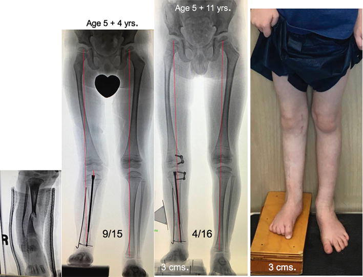 The role of guided growth as it relates to limb lengthening | SpringerLink