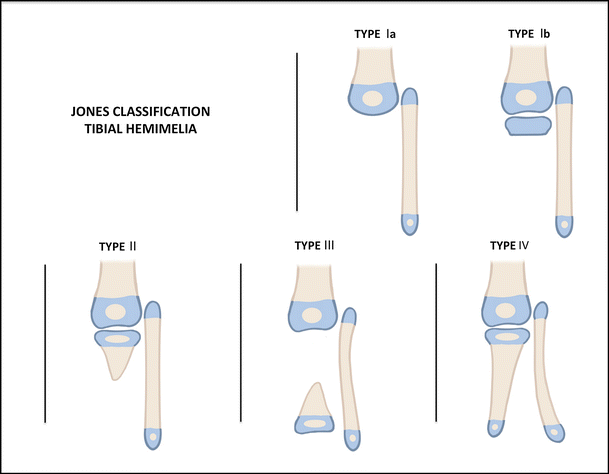 Tibial hemimelia: new classification and reconstructive options ...