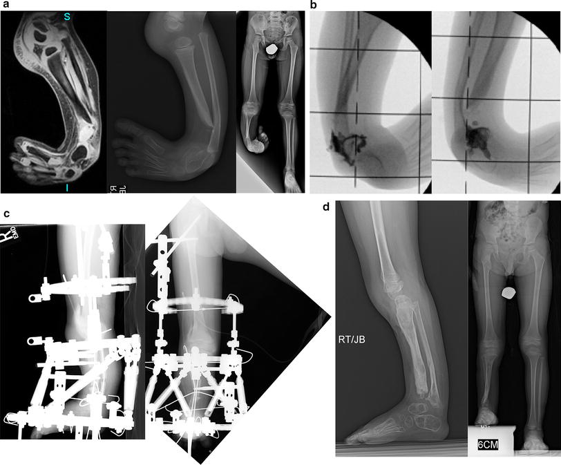 Tibial hemimelia: new classification and reconstructive options ...
