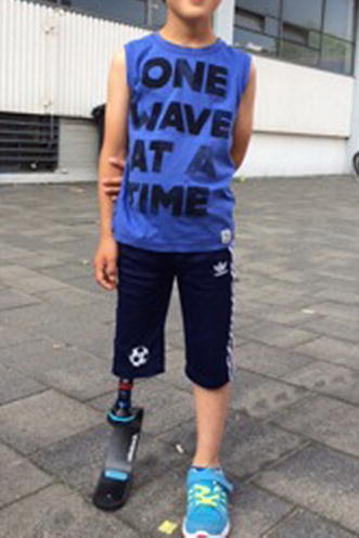 Amputation and rotationplasty in children with limb deficiencies ...