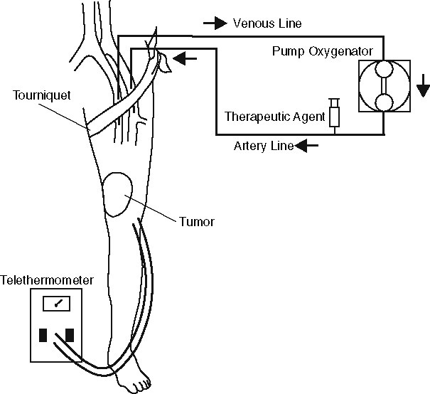 Isolated Limb Perfusion with Melphalan and TNF-α in the Treatment of ...