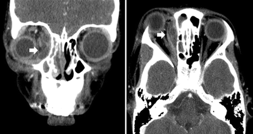 Acute Rhinosinusitis in Children | SpringerLink