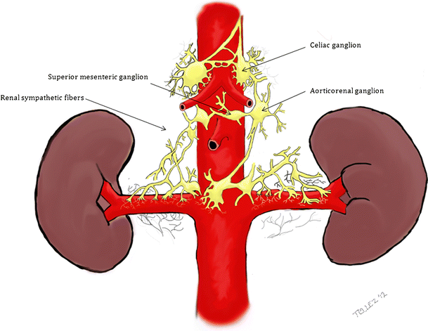 Renal Denervation Therapies for Refractory Hypertension | SpringerLink