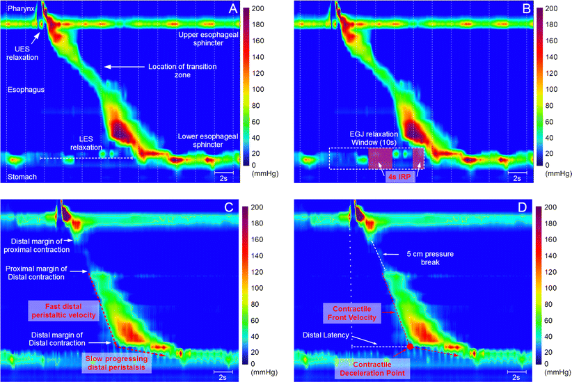 Clinical Applications of Esophageal Impedance Monitoring and High ...