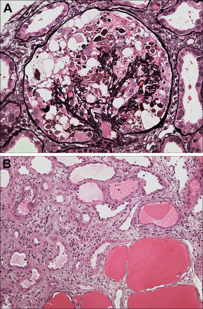 Differentiating HIV-associated Nephropathy from Antiretroviral Drug ...