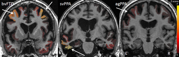 Recent Advances in the Imaging of Frontotemporal Dementia | SpringerLink