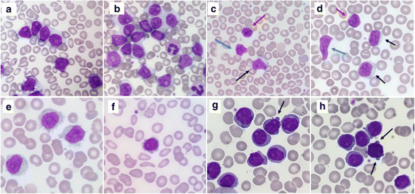 Prolymphocytic Leukemia: New Insights in Diagnosis and in Treatment ...