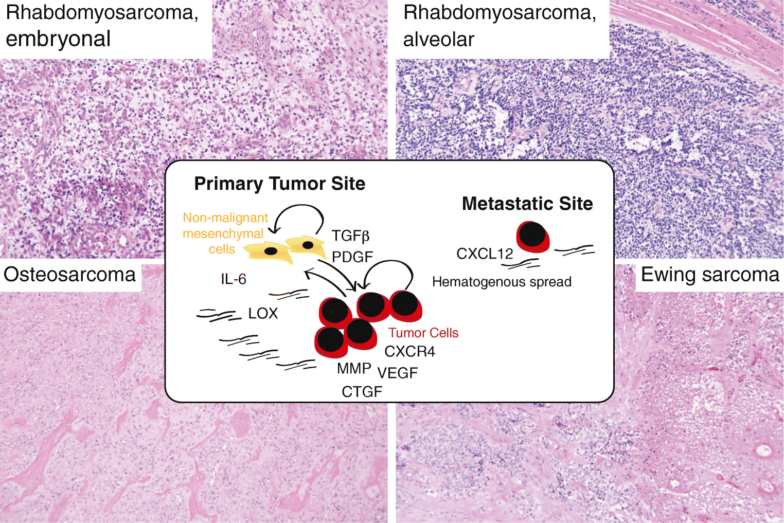 The Tumor Microenvironment of Pediatric Sarcoma: Mesenchymal Mechanisms ...