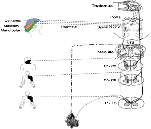 Cardiac Cephalgia | SpringerLink