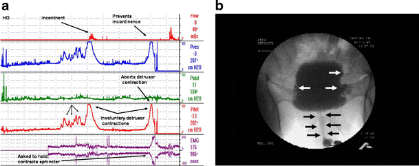 How Do Urodynamics Findings Influence the Treatment of the Typical ...