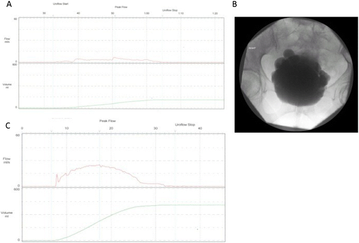 Bladder Outlet Obstruction in Women: Functional Causes | SpringerLink