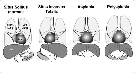 Fetal Situs, Isomerism, Heterotaxy Syndrome: Diagnostic Evaluation and ...