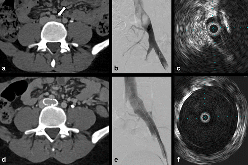 Venous Compression Syndromes: a Review | SpringerLink