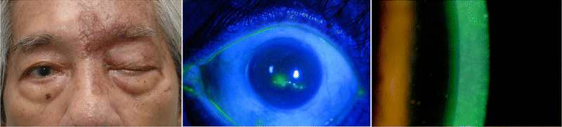 Herpes Zoster Ophthalmicus | SpringerLink