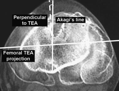 Rotational Position of Femoral and Tibial Components in TKA Using the ...