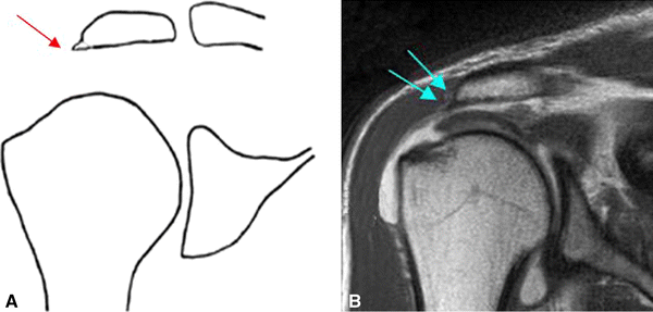 Classification and Clinical Significance of Acromial Spur in Rotator ...