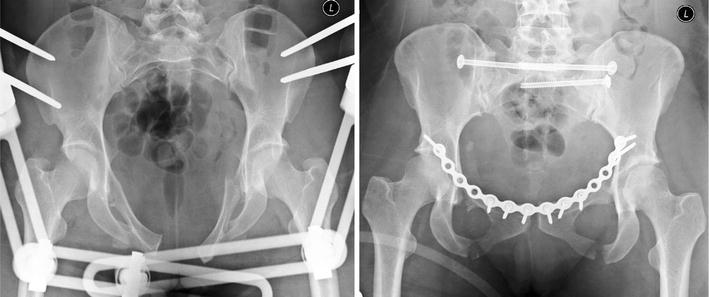 Is Fixation Failure After Plate Fixation of the Symphysis Pubis ...