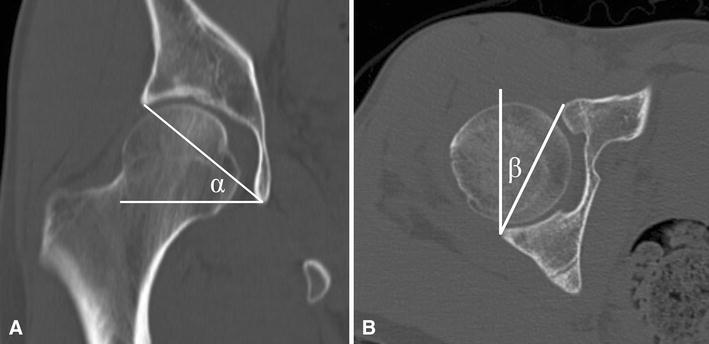 Acetabular Component Positioning Using Anatomic Landmarks of the ...