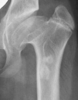 Reliability of Bucholz and Ogden Classification for Osteonecrosis ...