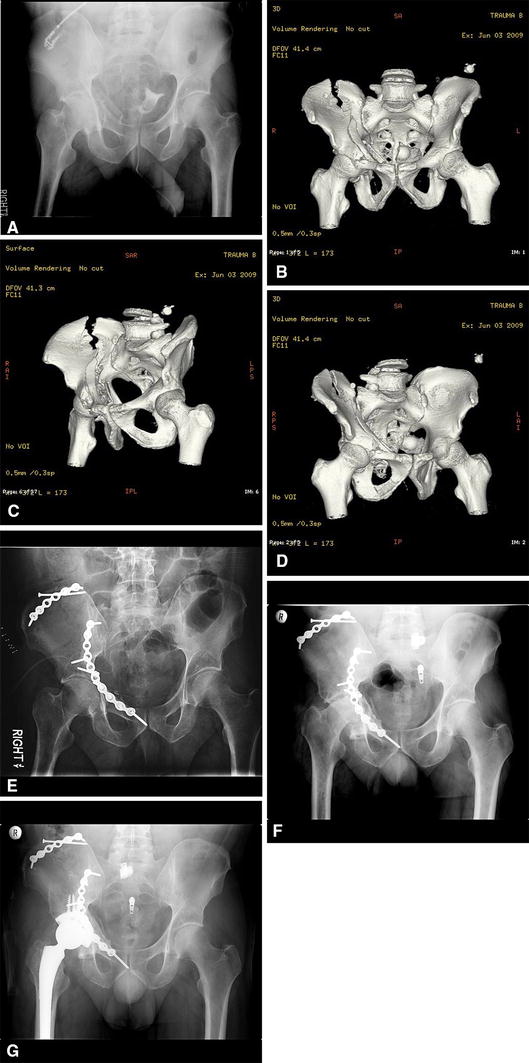 Treatment of Acetabulum Fractures Through the Modified Stoppa Approach ...