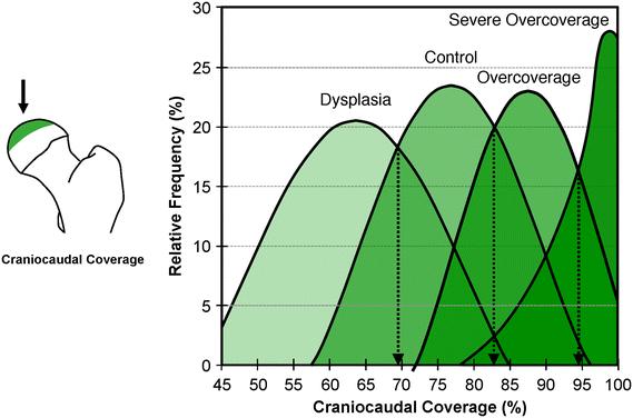 What Are the Radiographic Reference Values for Acetabular Under- and ...