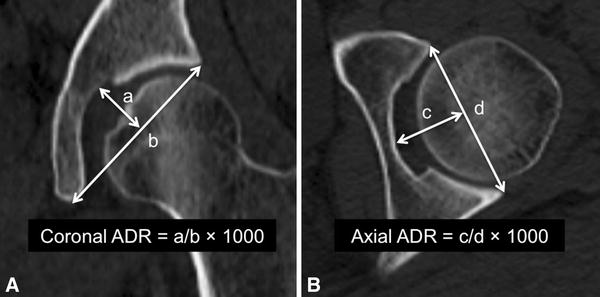 Does Radiographic Coxa Profunda Indicate Increased Acetabular Coverage ...
