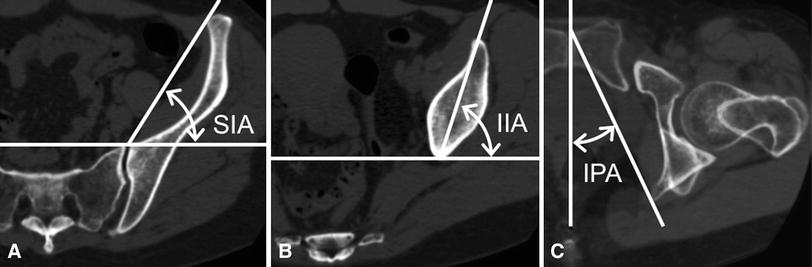 Does Radiographic Coxa Profunda Indicate Increased Acetabular Coverage ...