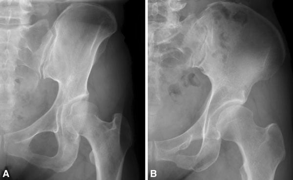 Does Radiographic Coxa Profunda Indicate Increased Acetabular Coverage ...