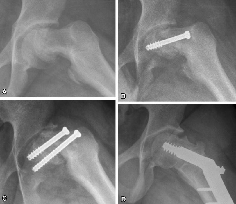 Modified Dunn Procedure is Superior to In Situ Pinning for Short-term ...