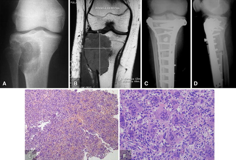 A High-grade Sarcoma Arising in a Patient With Recurrent Benign Giant ...