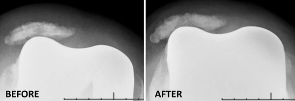 What Is the Role for Patelloplasty With Gullwing Osteotomy in Revision ...