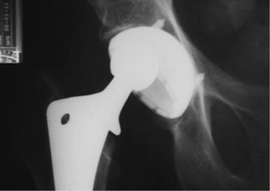 Polyethylene Liner Dissociation Is a Complication of the DePuy Pinnacle ...
