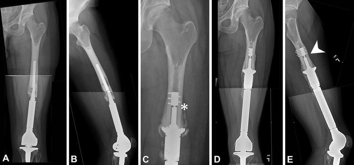 Revision Distal Femoral Arthroplasty With the Compress® Prosthesis Has ...